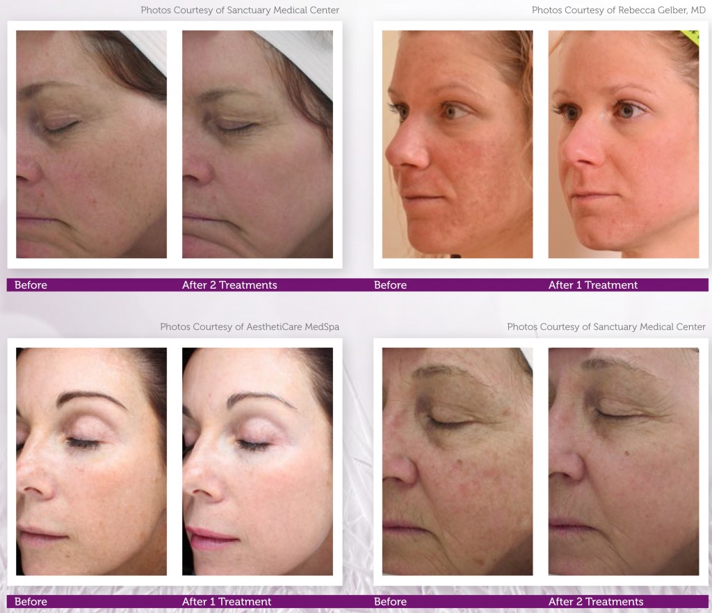 Resurfacing Laser - Halo - Radin Skin Centre