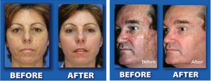 RESURFACING LASER - Radin Skin Centre