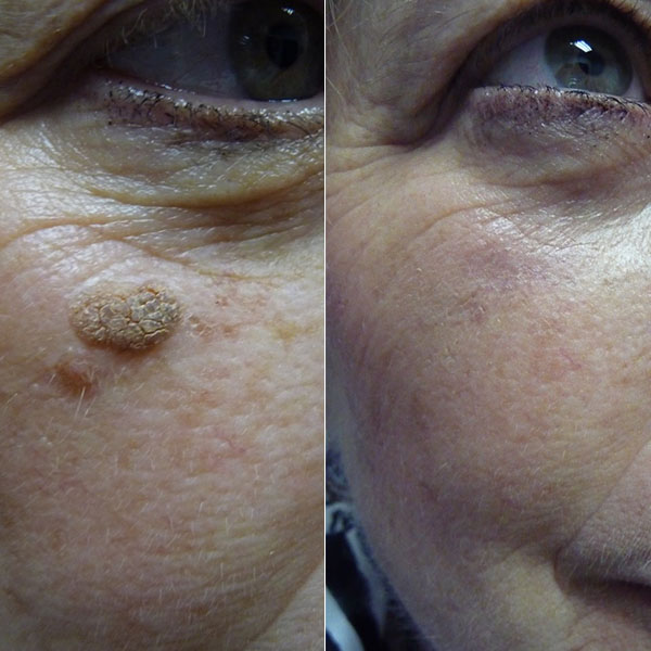 Mole, Skin Tag, Cyst & Wart Removal - Dr. Daniel Radin Windsor & Tecumseh